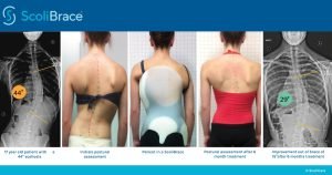 Scoliosis Bracing Exercises - Scoliosis Center of LA and House Call ...